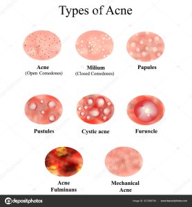 Diplomski rad- ACNE PAPULOPUSTULOSA - Akademija